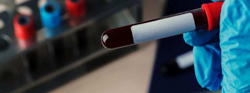 LFT Blood Test in Kolkata - SGOT SGPT, Alkaline Phosphatase